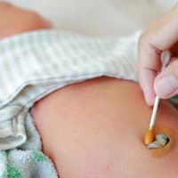 Nabelbruch bei Babys und Kleinkindern – in der Regel nicht schlimm