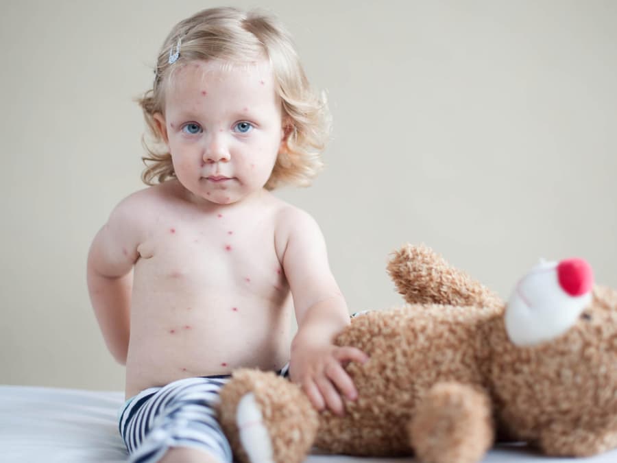 Sind Masern wirklich so gefährlich?